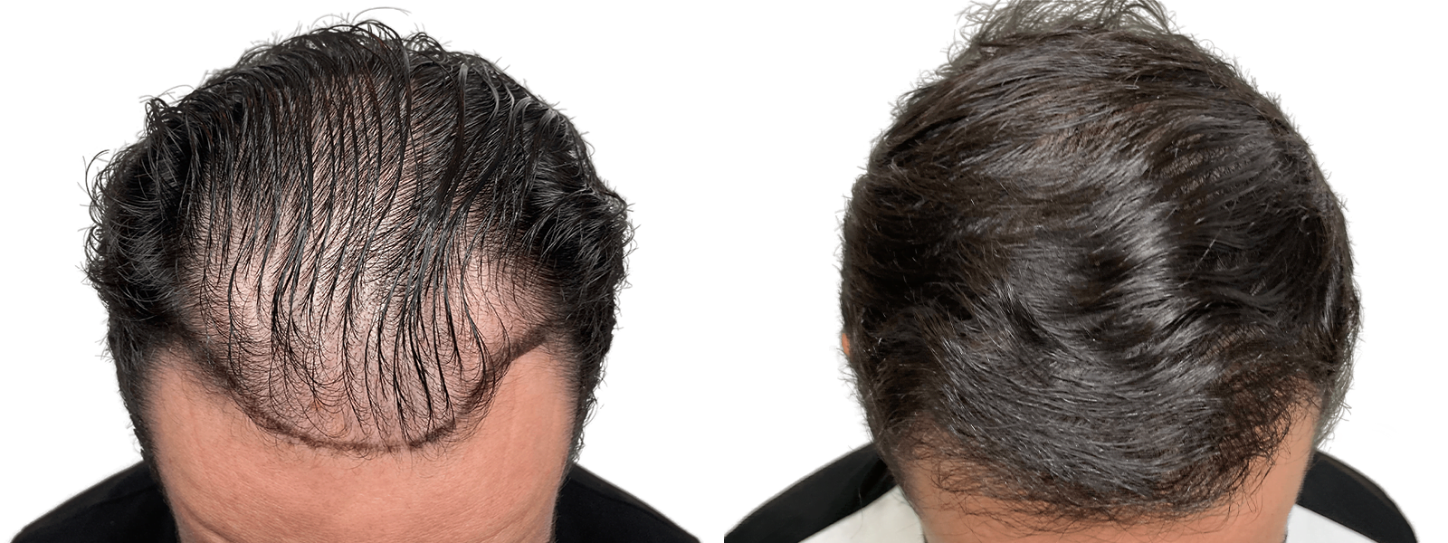 Hair Transplant Before and After Transformations You Should See